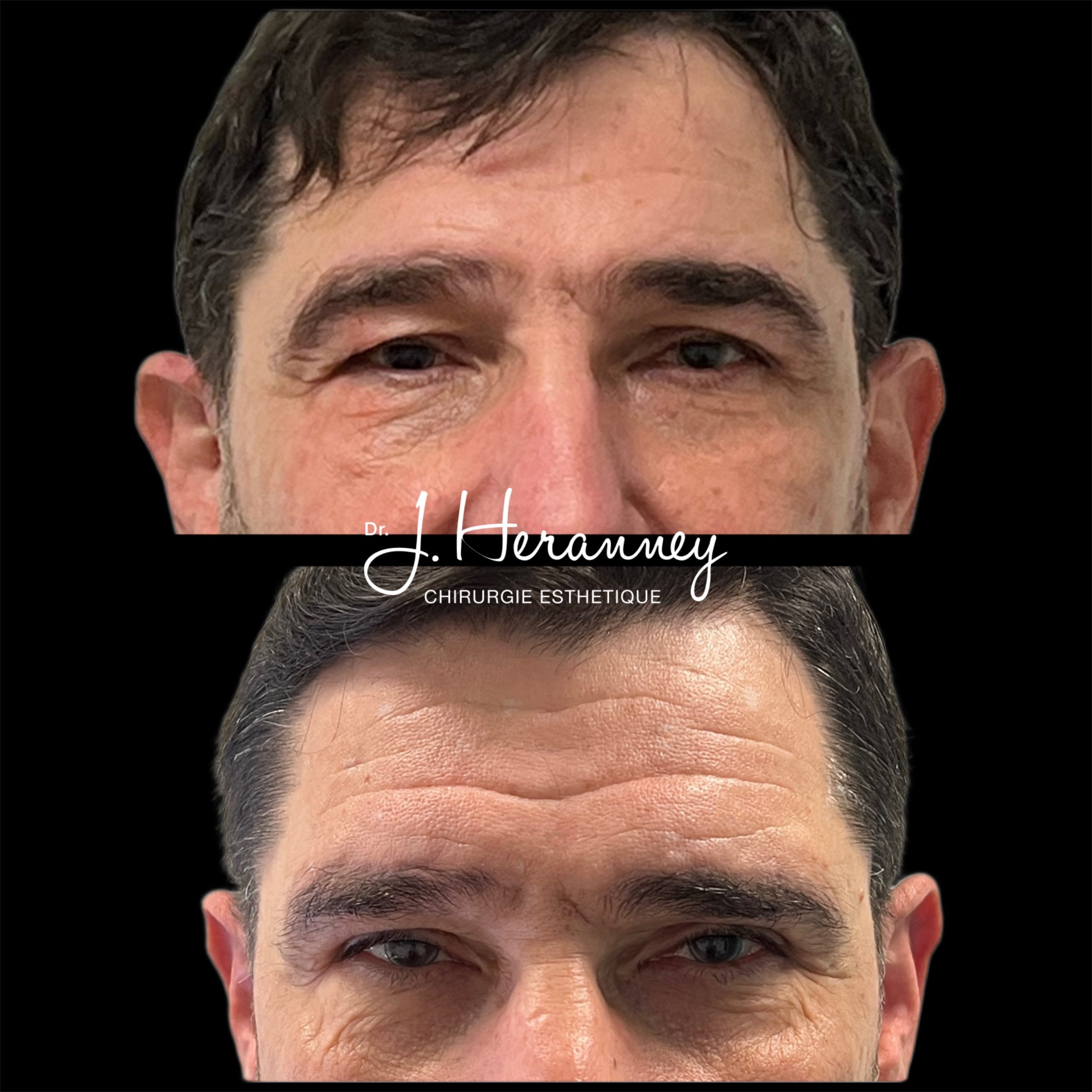 Blépharoplastie chez l'Homme à Paris 7 & Versailles | Dr Heranney